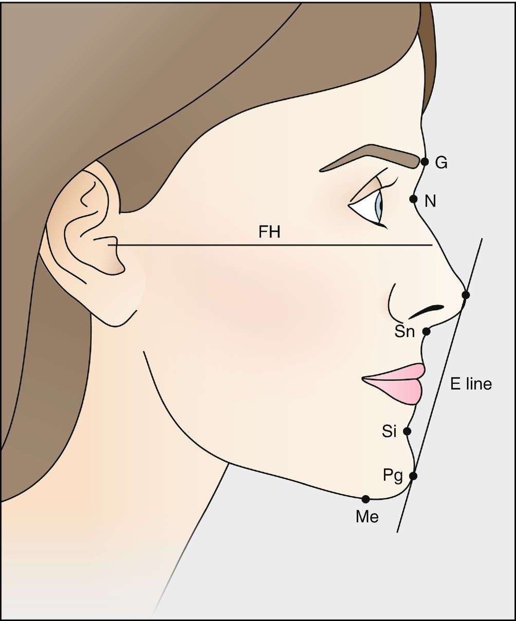 Chin Fillers Singapore | A Full Guide | A.M Aesthetic Clinic